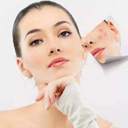 Deep Acne Facial Treatment - Makhsoom